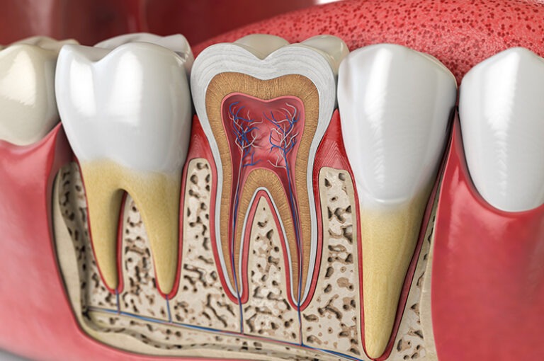 Root Canals | Murphy Dental Group